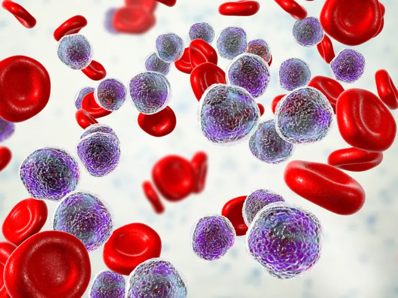 Impact of allo-HSCT on survival outcomes in accelerated/blast-phase MPN Impact of allo-HSCT on survival outcomes in accelerated/blast-phase MPN