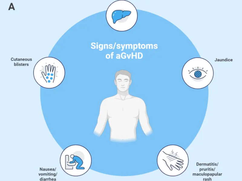 Acute and chronic GvHD: An overview